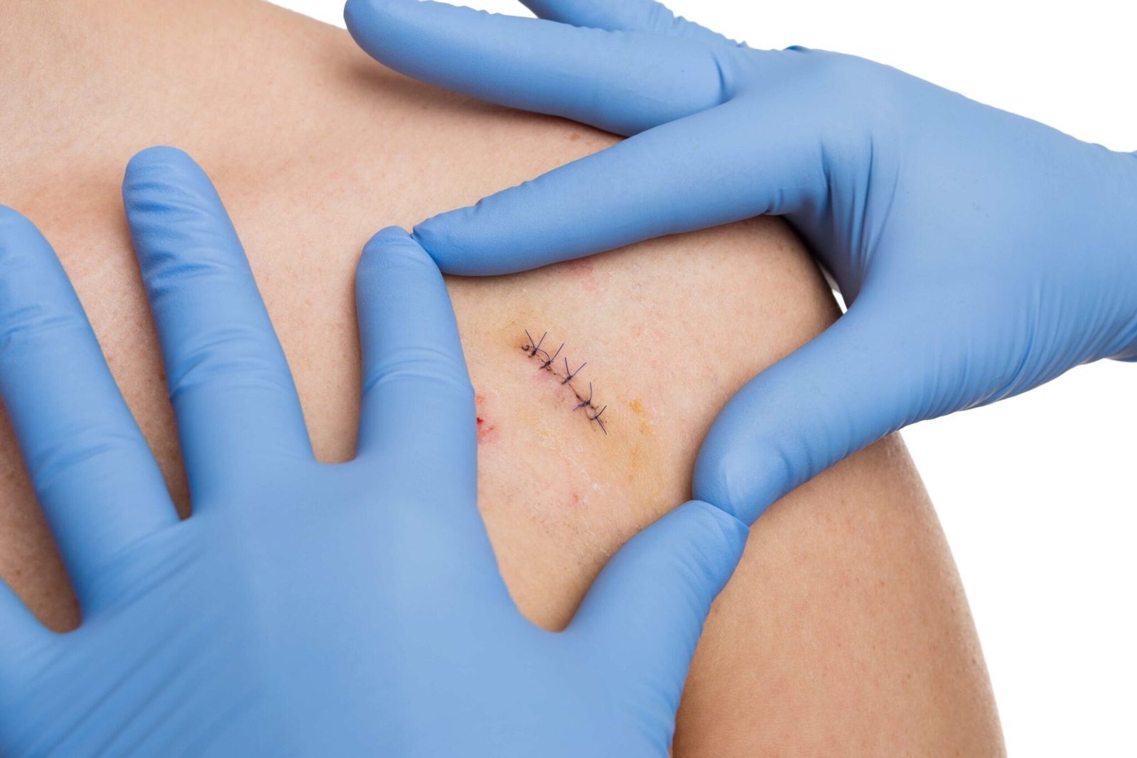 Debridement and Suture Removal - Nikaweratioya Medical and Wound Care ...